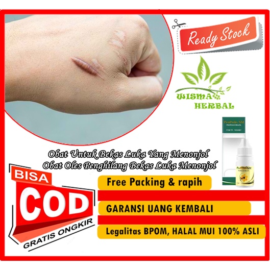 Jual Obat Untuk Bekas Luka Yang Menonjol, Obat Oles Penghilang Bekas ...