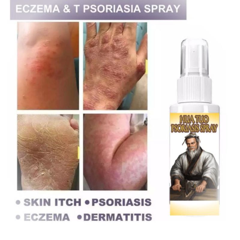 Jual SALEP GATAL PSORIASIS SPRAY | Shopee Indonesia