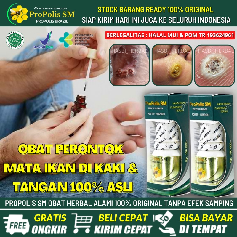 Jual Obat Mata Ikan Kaki & Tangan, Obat Oles Hilangkan Mata Ikan Yang ...