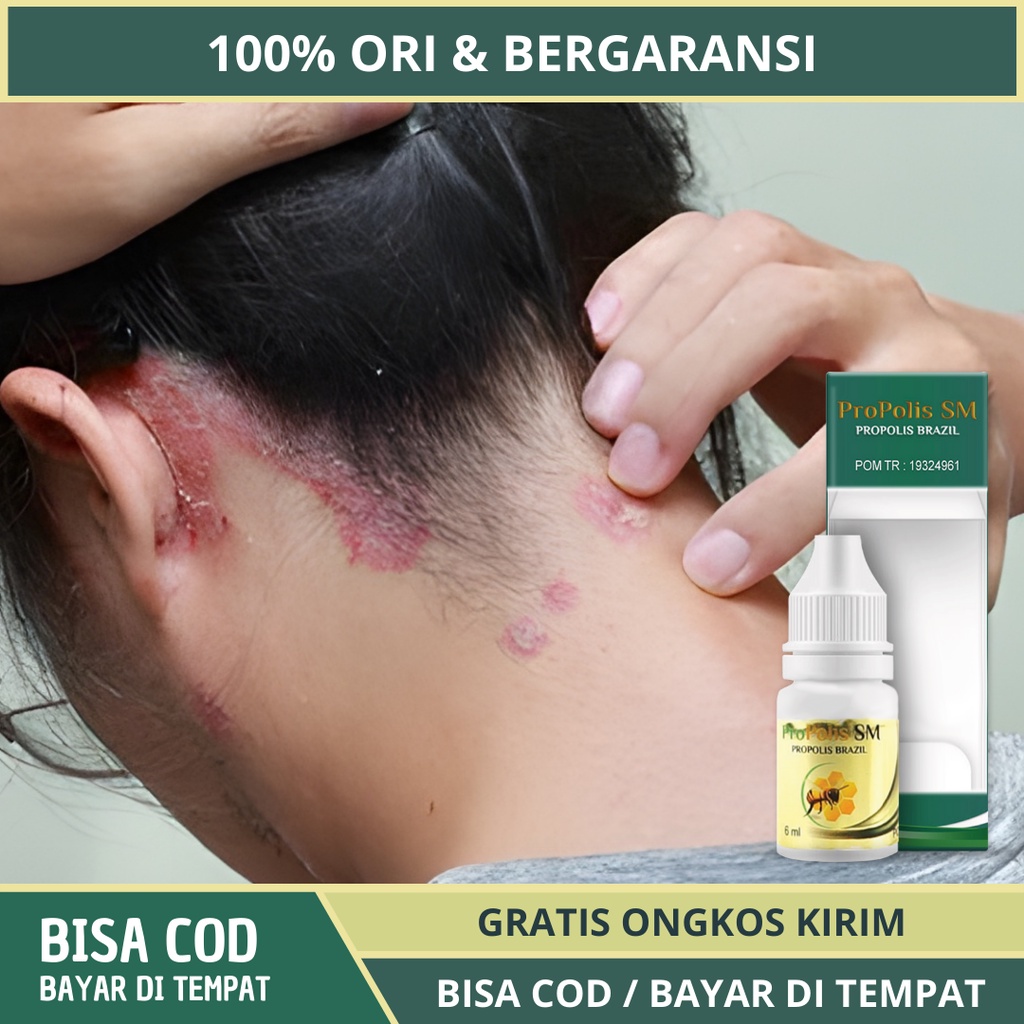 Jual Obat Borok di Kepala, Kulit Kepala Gatal Kering Berkerak Bersisik, Ketombe Berkerak Parah ...