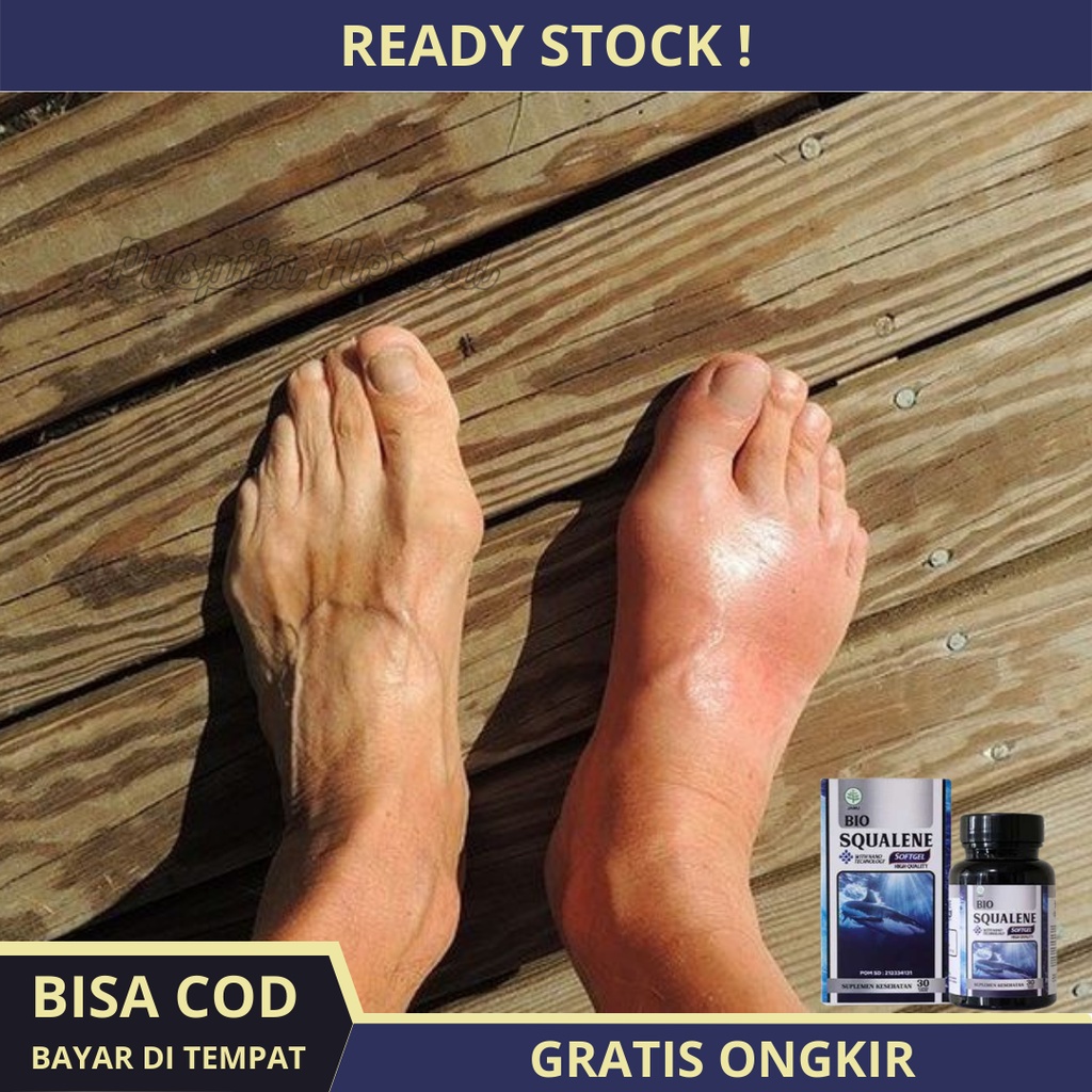 Jual Obat Kaki Bengkak, Obat Bengkak Pada Kaki, Obat Kaki Bengkak ... Jual Obat Kaki Bengkak, Obat Bengkak Pada Kaki, Obat Kaki Bengkak ...