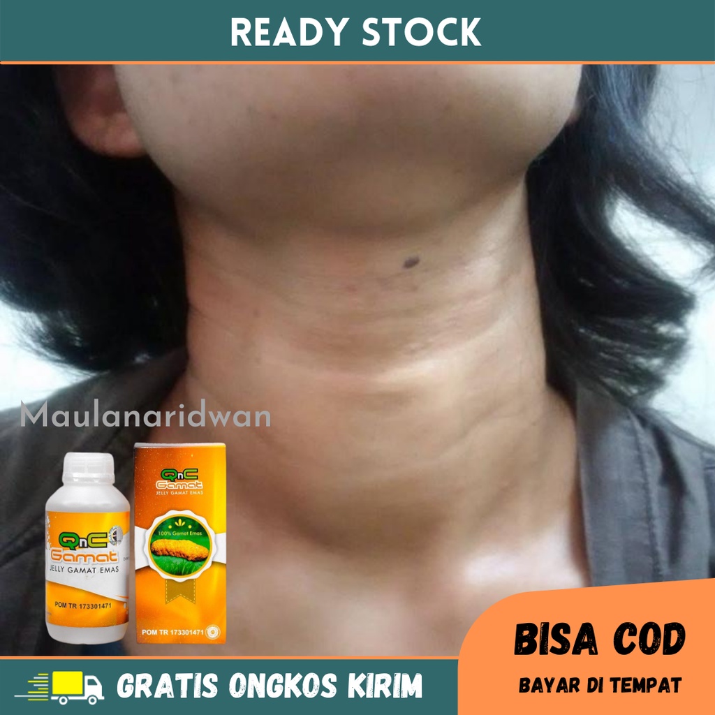 Jual Obat Gondok Beracun - Obat Hipertiroid, Obat Tiroid Di Leher, Obat ...