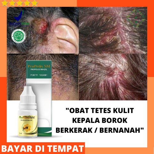 Jual Obat Borok Kulit Kepala Bernanah Berdarah Korengan Bau Amis Berkerak Lengket Ketombe Parah ...