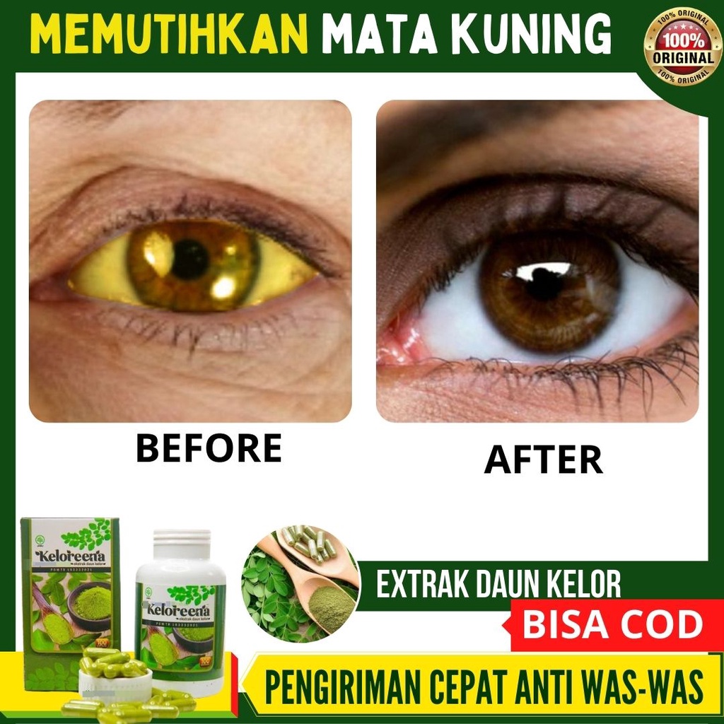 Jual Cara Memutihkan Mata Kuning Secara Alami, Obat Mata Kuning di ...