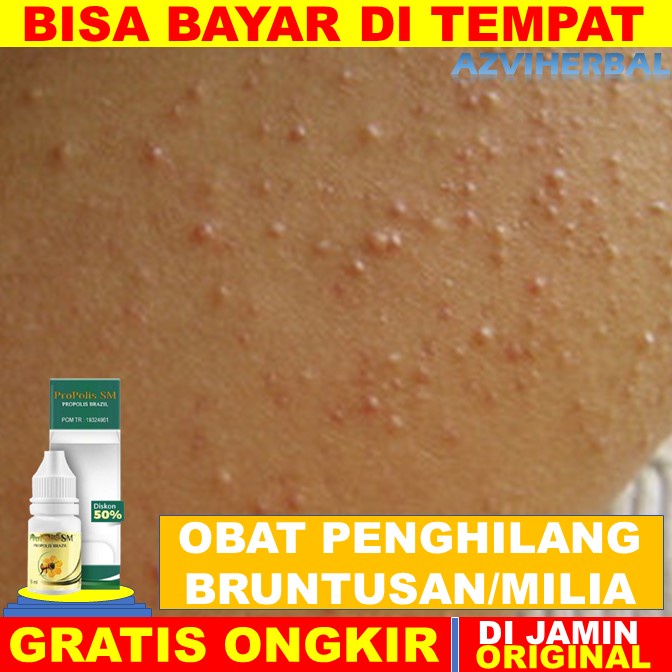 Jual Obat bruntusan wajah, obat beruntusan, obat beruntusan wajah, obat ...