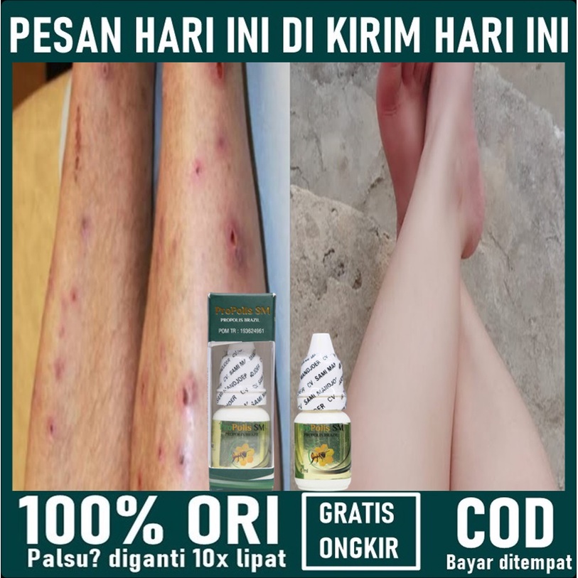 Jual Obat Penghilang Koreng di Kaki - Penghilang bekas Luka di kaki ...