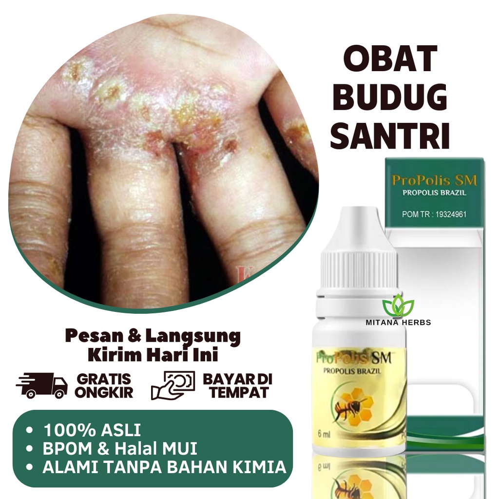 Jual Obat Budug Santri, Obat Budug Dan Gatal, Obat Budug Bernanah, Obat ...