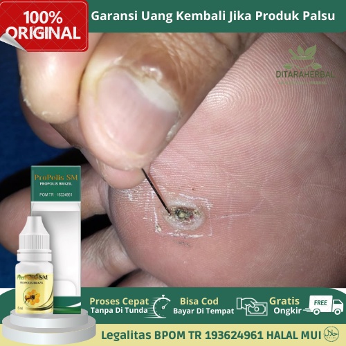 Jual Obat Mata Ikan, Obat Mata Ikan Telapak Kaki, Obat Tetes Mata Ikan ...