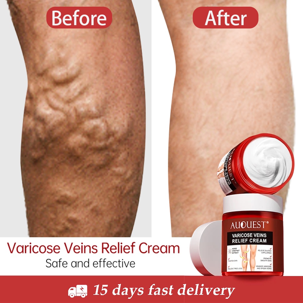 Jual Spataderen Relief Crème Vasculitis Phlebitis Spider ...