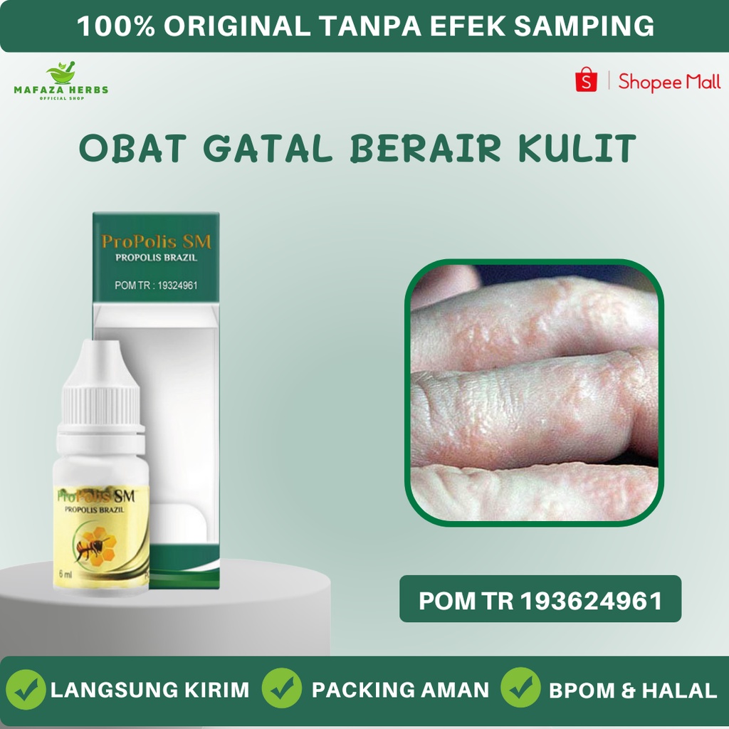 Jual Obat Gatal Berair Di Jari Tangan Dan Kaki Gatal Bintik Berair ...