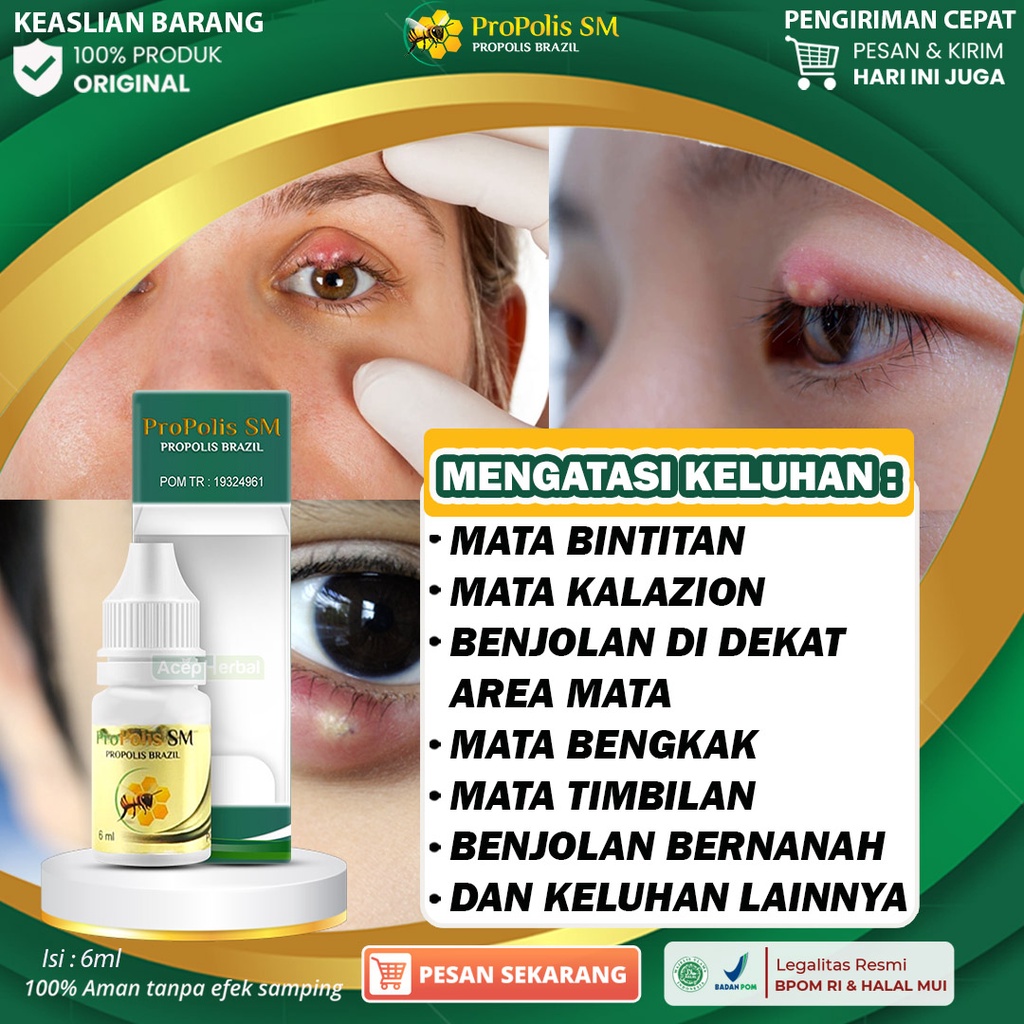 Jual Obat Mata Bintitan Kalazion Mata Timbilan Bernanah Benjolan di ...