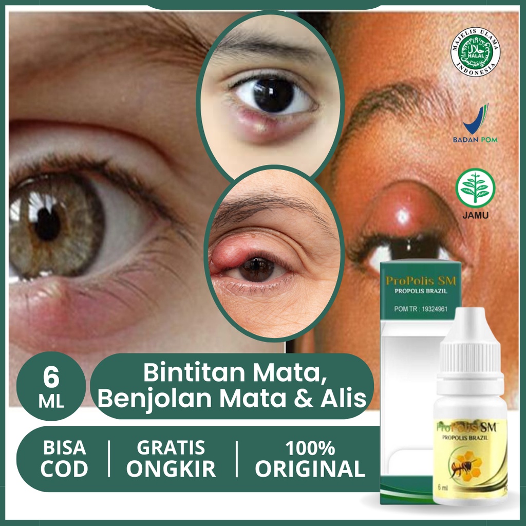 Jual Obat Bintitan Mata yang Susah Hilang Pada Anak dan Dewasa ...
