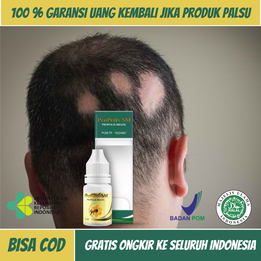 Jual Obat Alopecia Areata Kebotakan Rambut Pada kepala Penumbuh Botak Koin Penumbuh Rambut Pitak ...