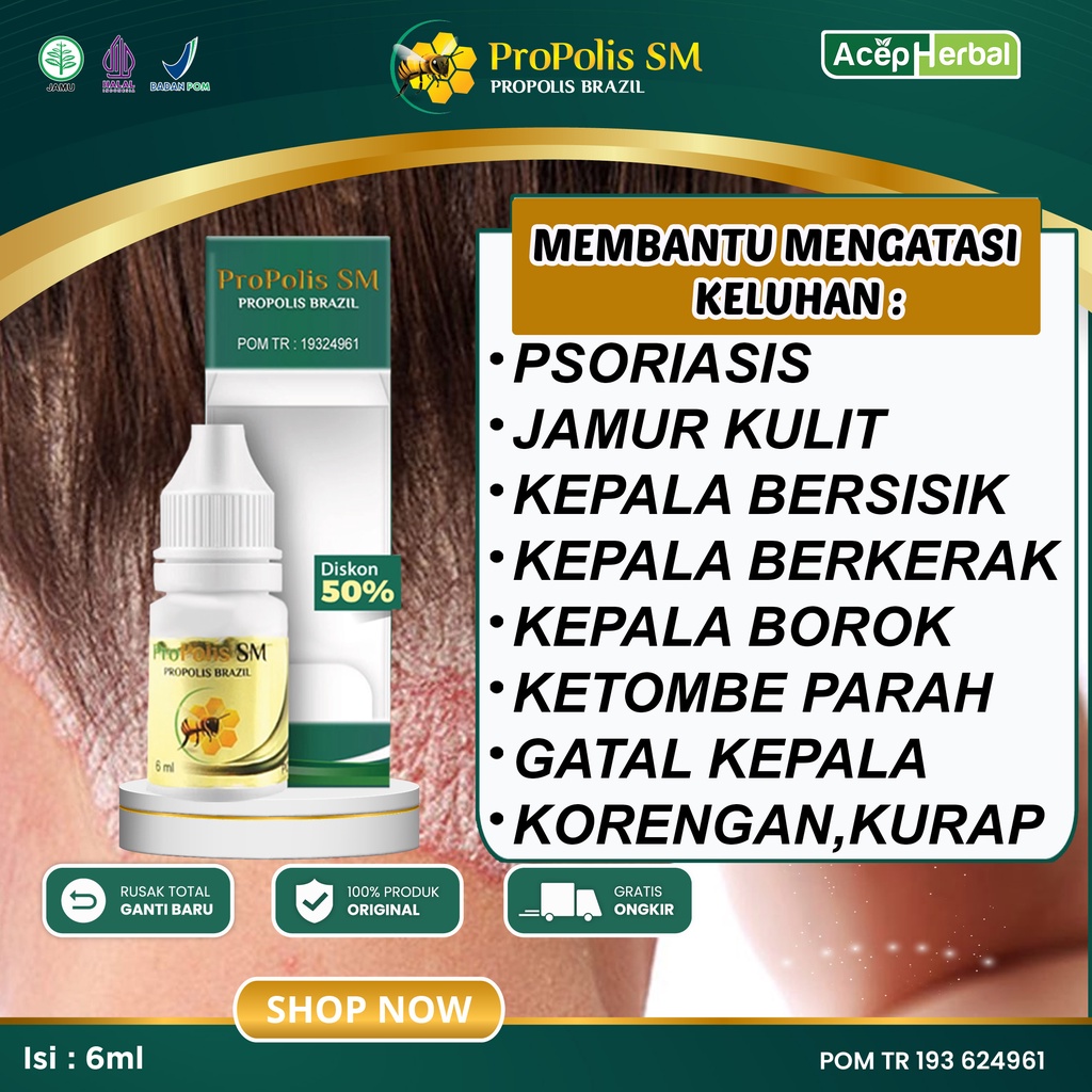 Jual Obat Psoriasis Kulit Kepala Jamur Bersisik Berkerak Ketombe Parah Gatal Kepala Borok Kurap ...