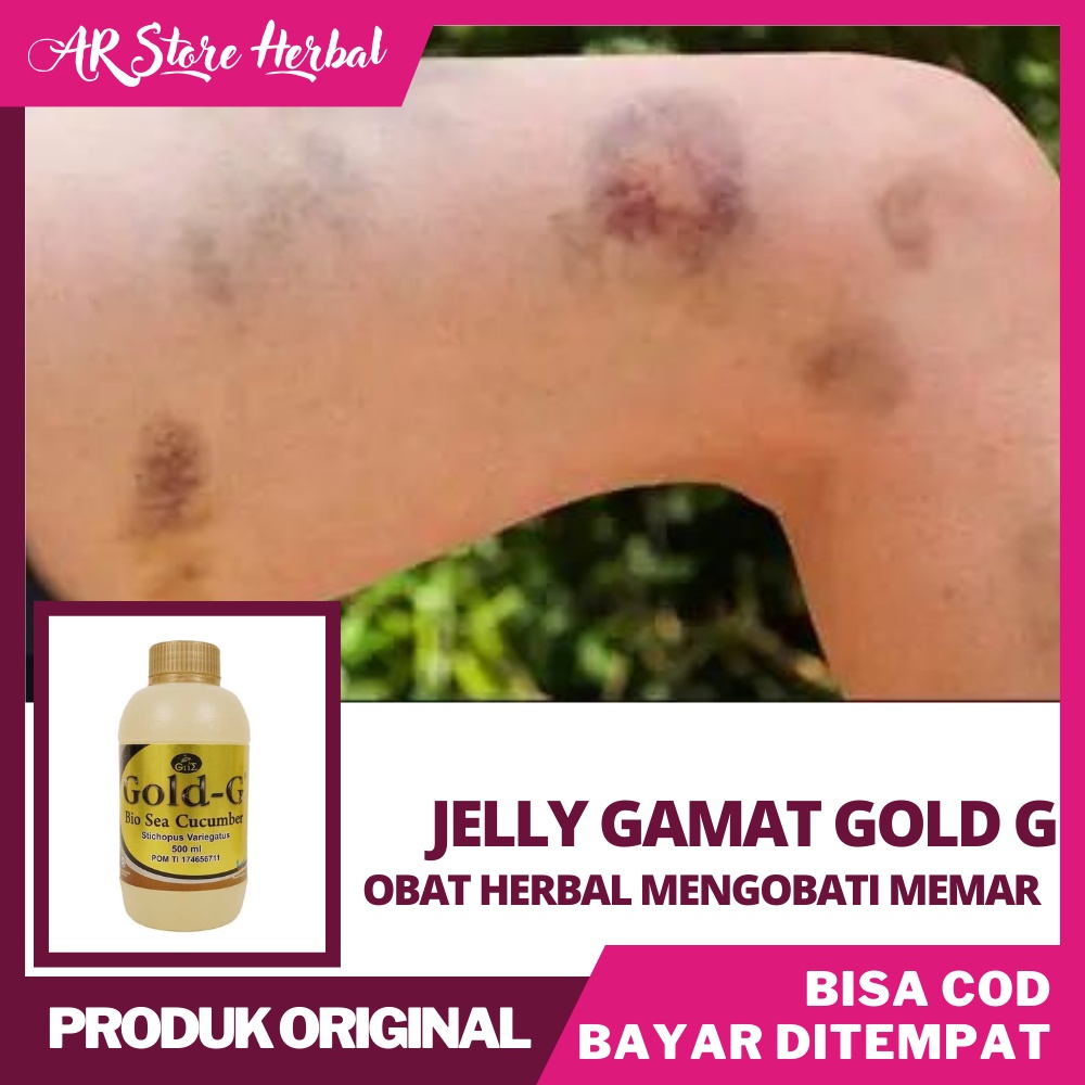 Jual GOLD -G Obat Herbal Penyakit Autoimun,Mengobati Itp Paling Ampuh ...