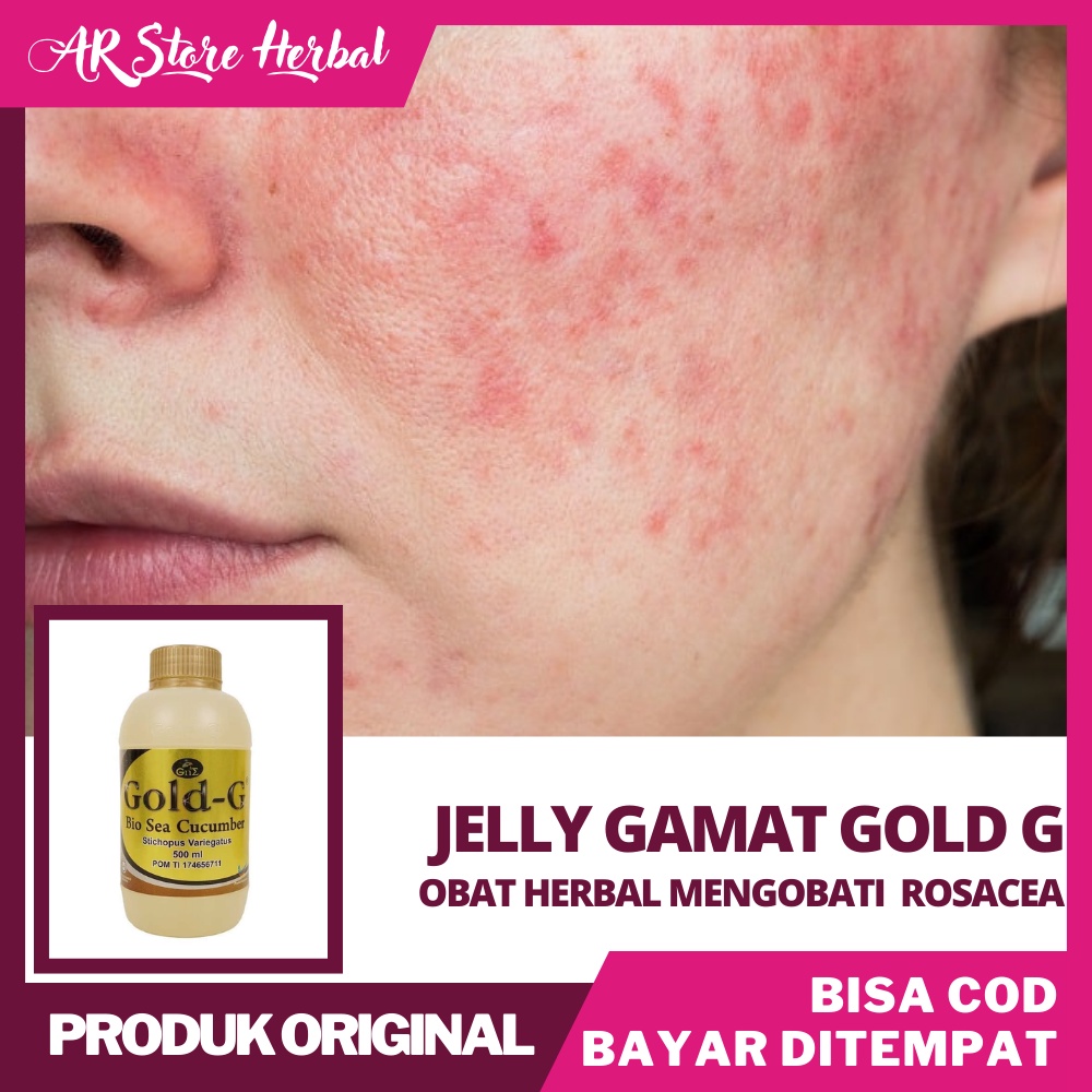 Jual Obat Menghilangkan Rosacea,Kulit Kemerahan,Kulit Perih,Kulit ...
