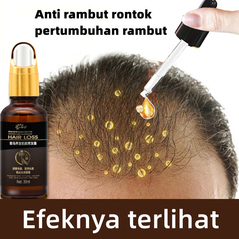 Jual Penumbuh rambut botak Serum penumbuh rambut 30ml Penumbuh rambut ...