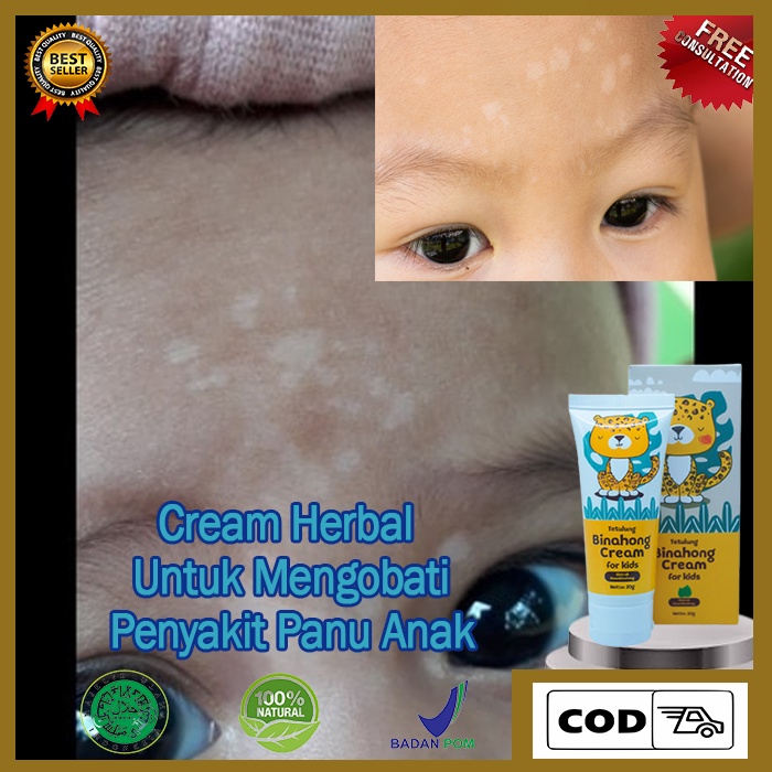 Jual Tetulung Cream Kids Salep Obat Panu Bintik Putih Di Wajah Dan Badan Anak Anak Bayi Balita ...