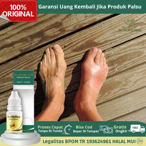 Jual Obat Nyeri Kaki Bengkak, Obat Kaki Bengkak, Obat Betis Bengkak ...