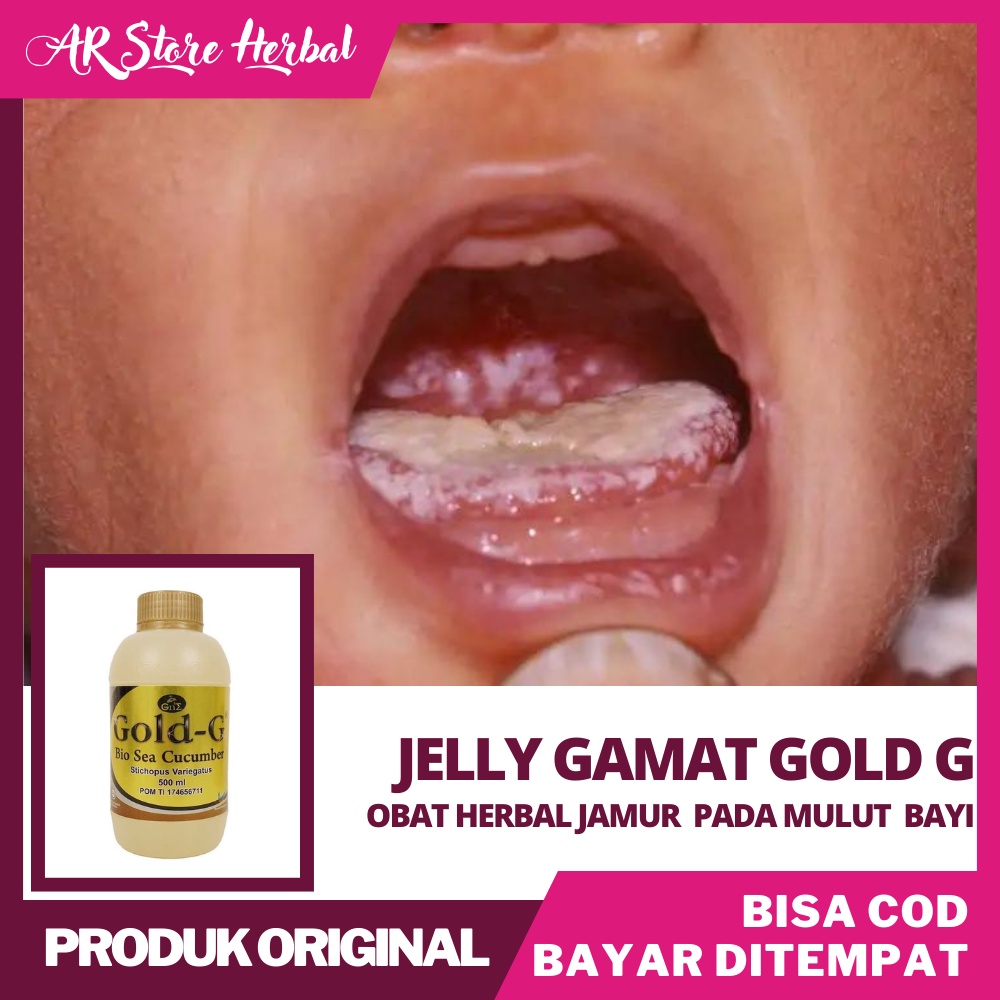 Jual GOLD -G OBAT LIDAH PUTIH PADA BAYI , OBAT JAMUR DI MULUT,OBAT ...