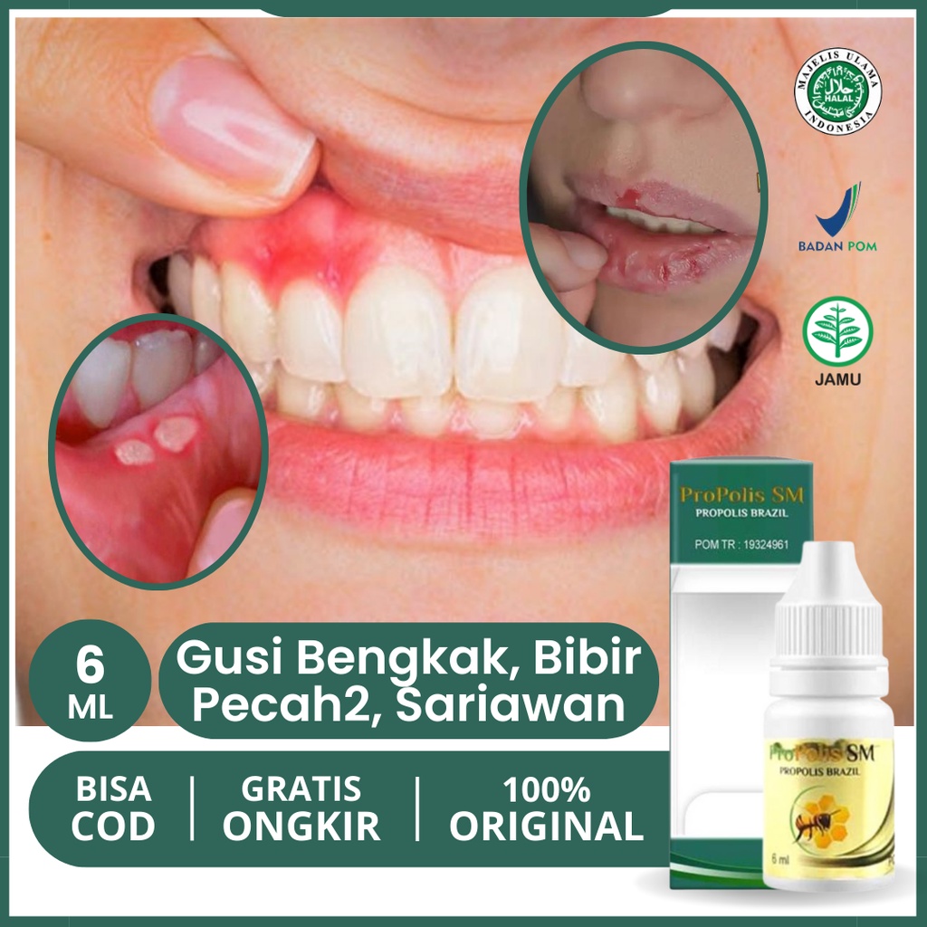 Jual Obat Bengkak Gusi Sakit Gigi Bintik Putih di Bibir Mulut Kering ...