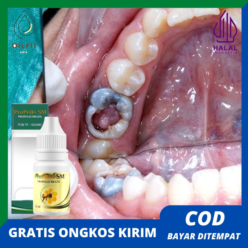 Jual Obat Kumur Polip Gigi Polip pulpa gigi Obat Benjolan pada Gigi ...