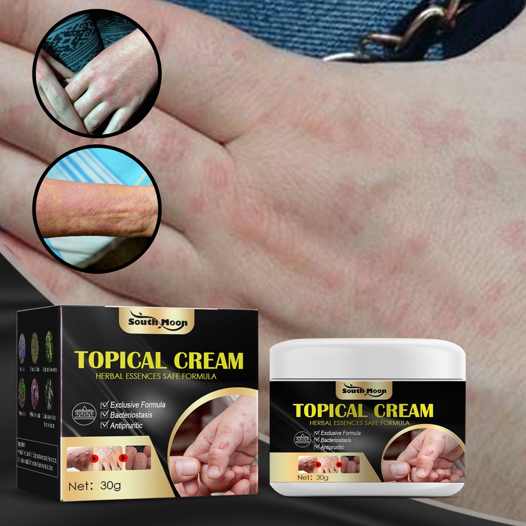 Jual [100% Asli ] Krim anti gatal gigitan nyamuk, krim anti gatal ...