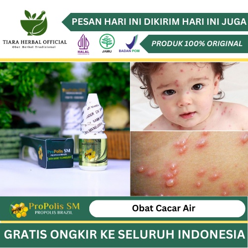 Jual Obat Cacar, Cacar Air, Bentol Bentol, Gatal Bernanah, Gatal ...