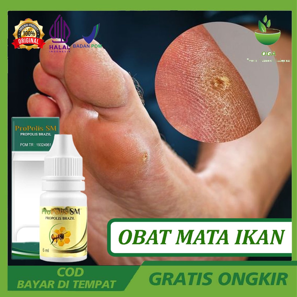 Jual Obat Perontok Mata Ikan Obat Mata Ikan Pada Telapak Kaki & Tangan ...