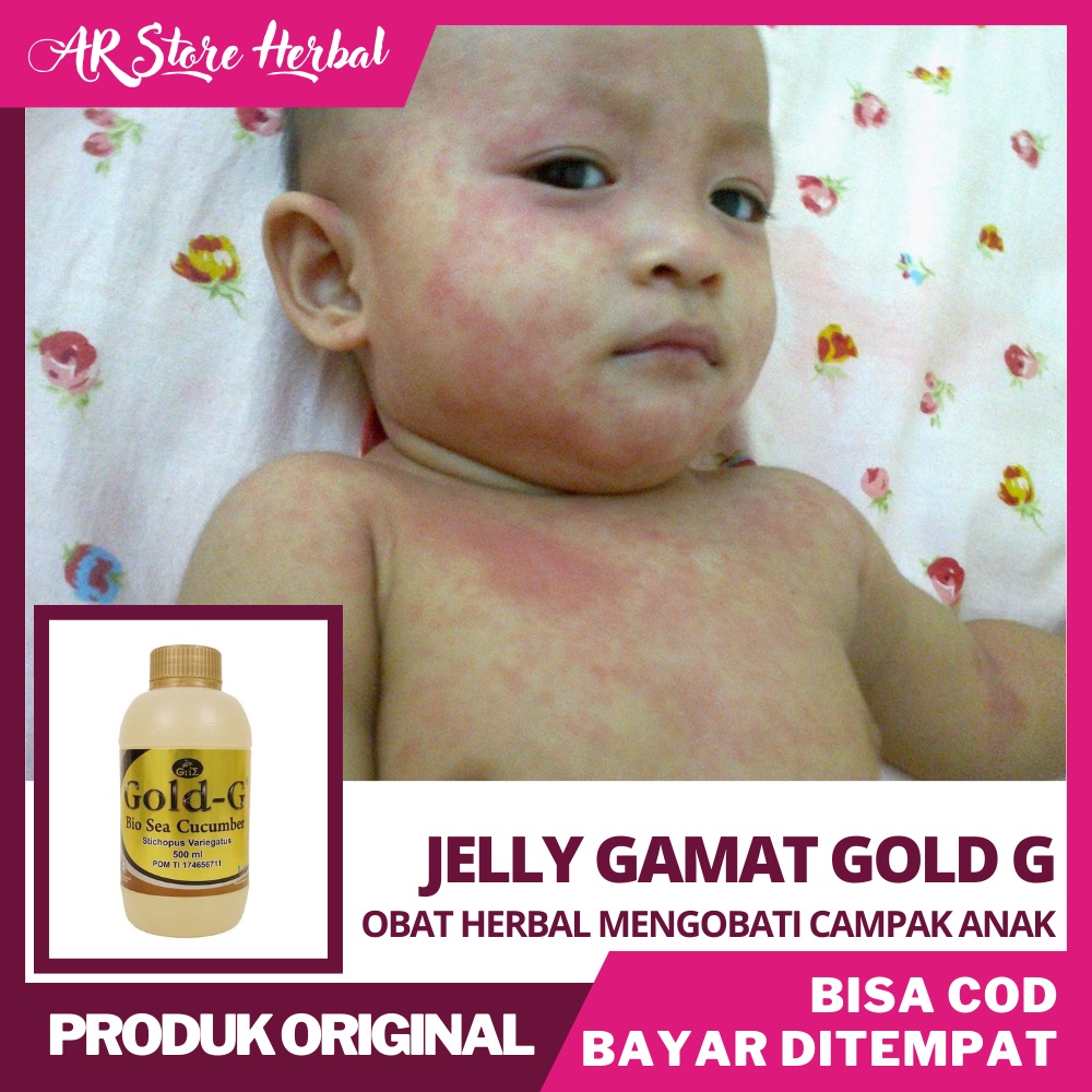 Jual JELLY GAMAT GOLD-G Obat Ruam Kemerahan. Obat Ruam Di Seluruh Tubuh ...