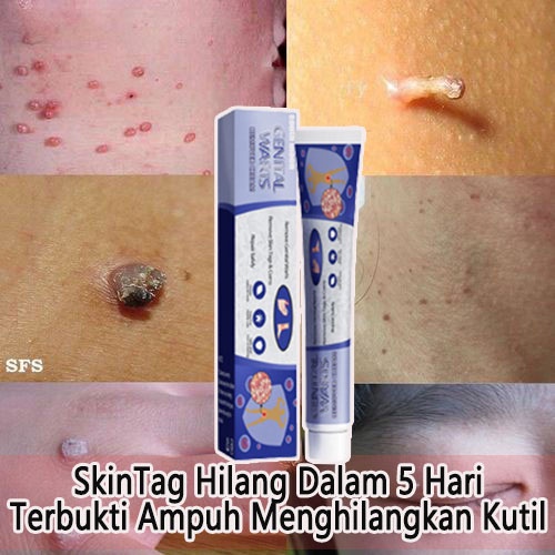 Jual krim penghilang kulit skin tag krim penghilang tahi Lalat Krim ...