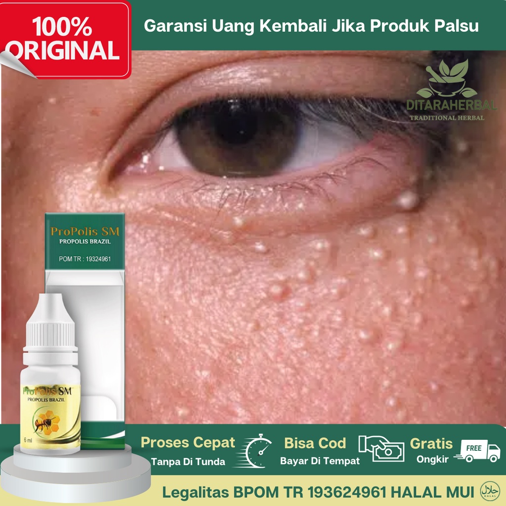 Jual Obat Milia, Obat Tetes Milia, Obat Milia Dibawah Mata, Obat Milia ...