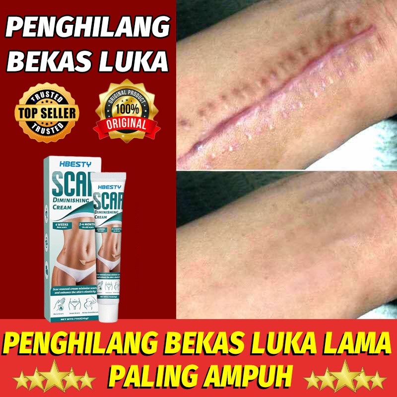 Salep Untuk Operasi Caesar - Perumperindo.co.id