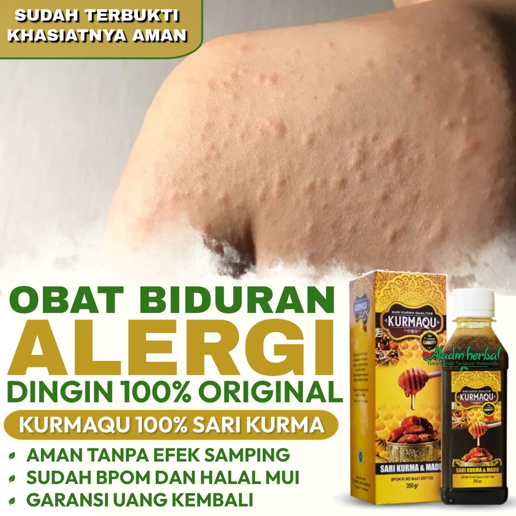 Jual Obat Biduran, Alergi, Kaligata Akut, Gatal-Gatal, Kaligata Menahun ...
