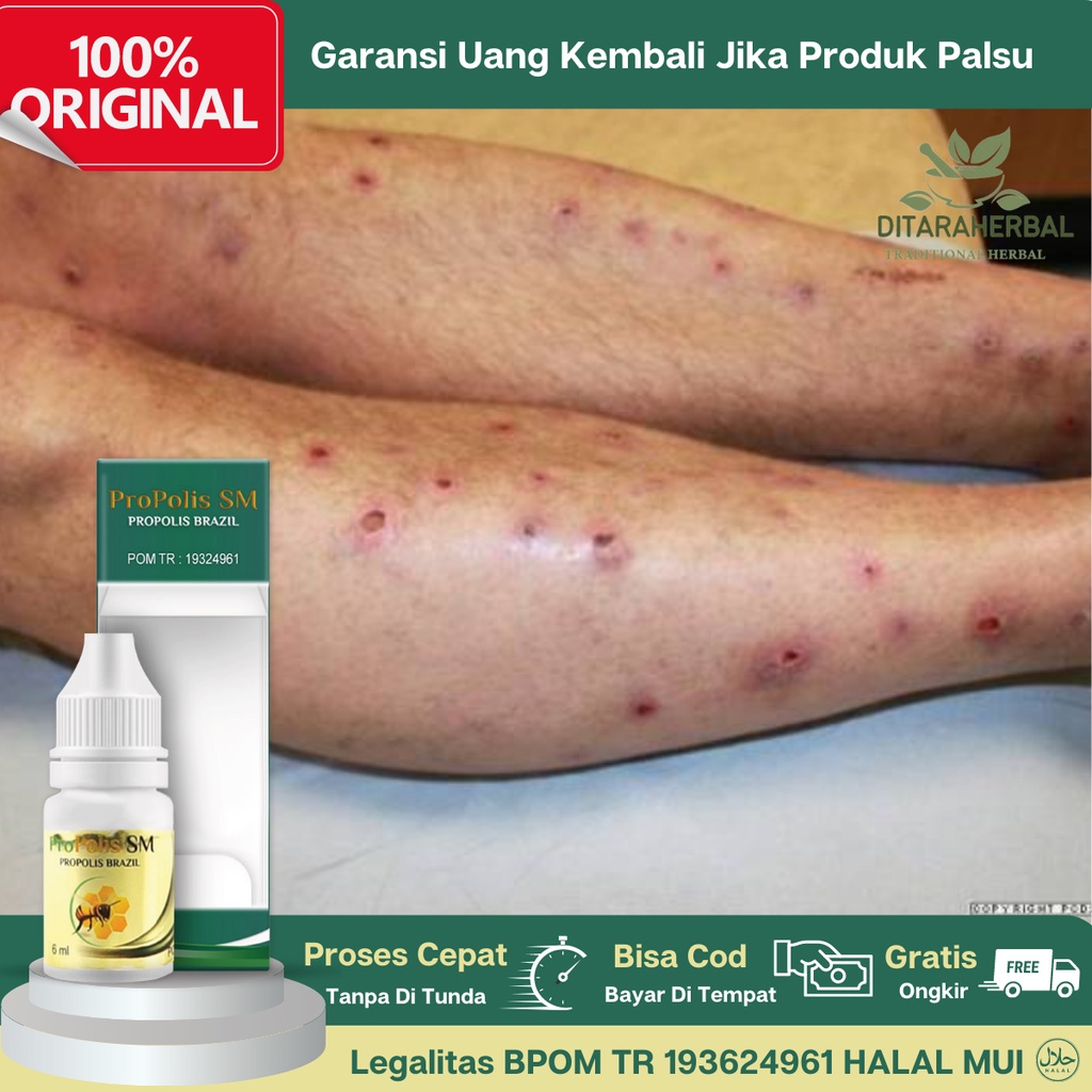 Jual Obat Penghilang Gatal Darah Manis, Obat Gatal Darah Manis, Obat ...
