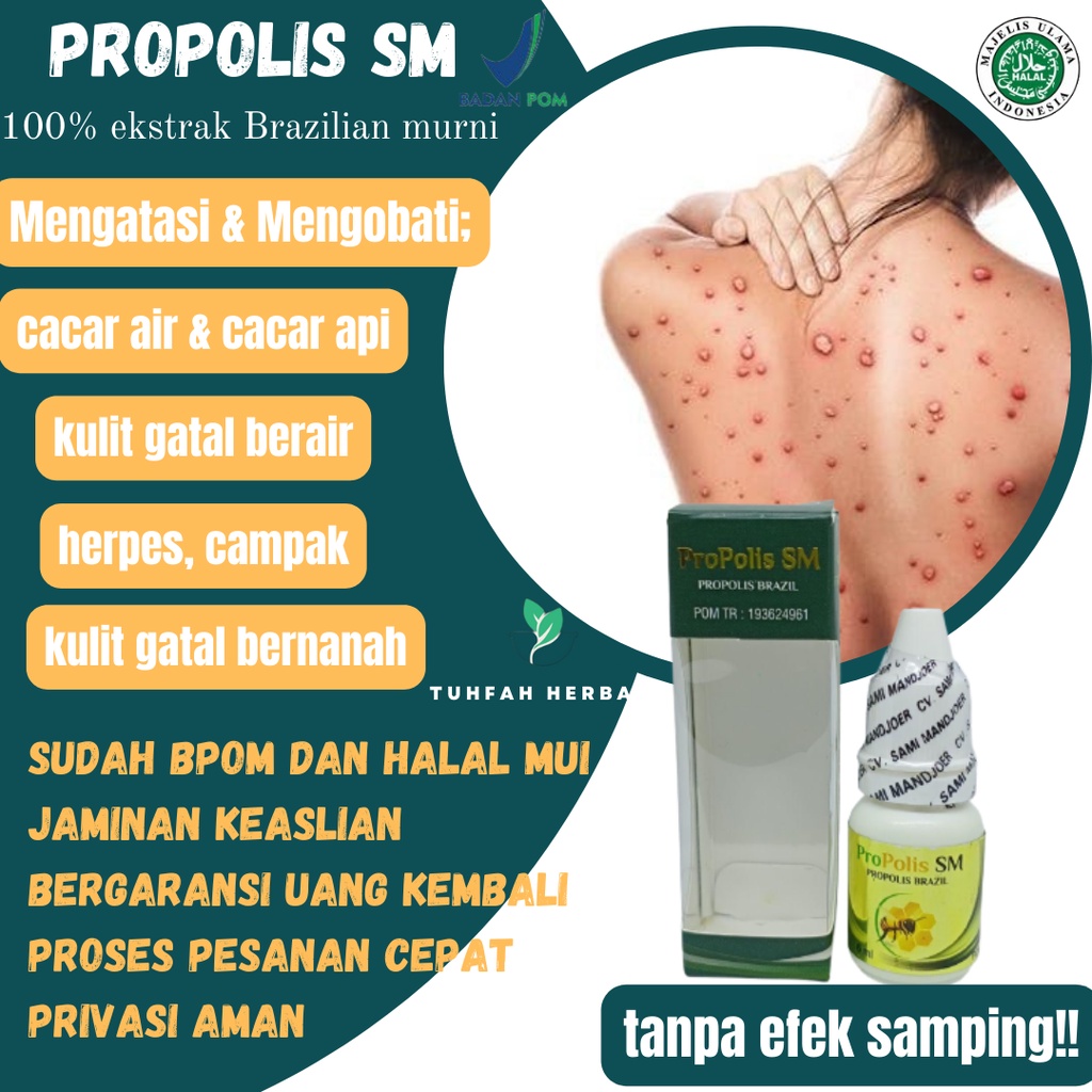 Jual Obat Cacar Air Cacar Api Cacar Monyet Herpes Campak Luka bakar ...