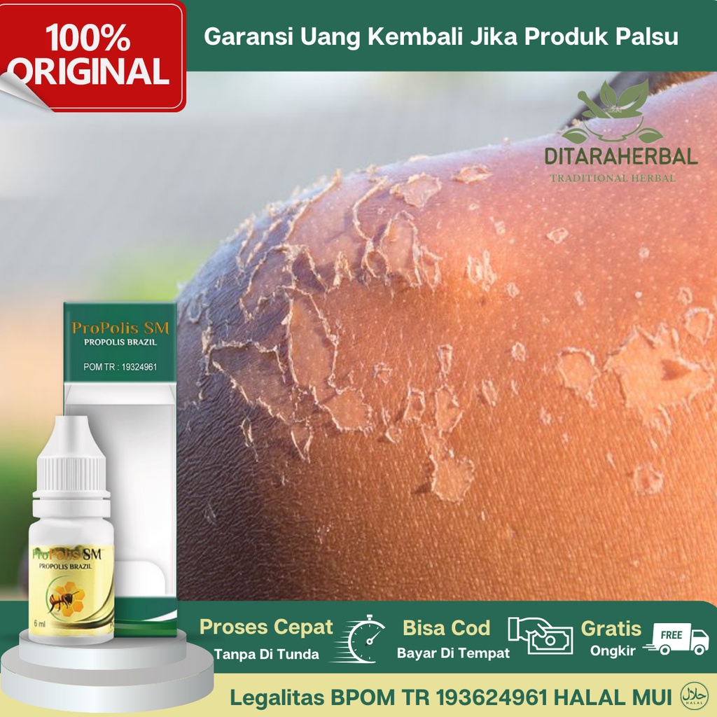 Jual Obat Jari Tangan Mengelupas, Obat Jari Tangan Kering, Obat Telapak ...