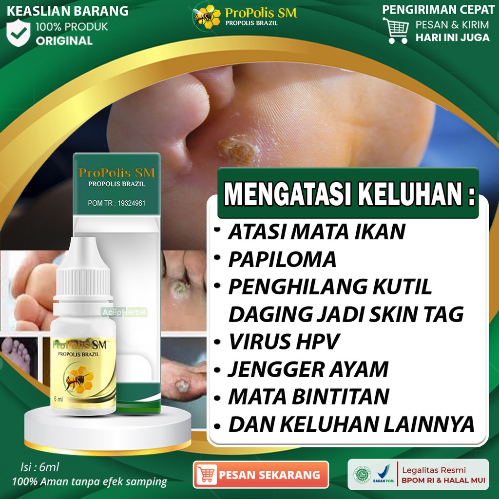 Jual Obat Tetes Perontok Mata Ikan Kutil Kelamin Daging Jadi Skin Tag ...
