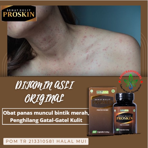 Jual Obat panas muncul bintik merah, Penghilang Gatal-Gatel Kulit ...