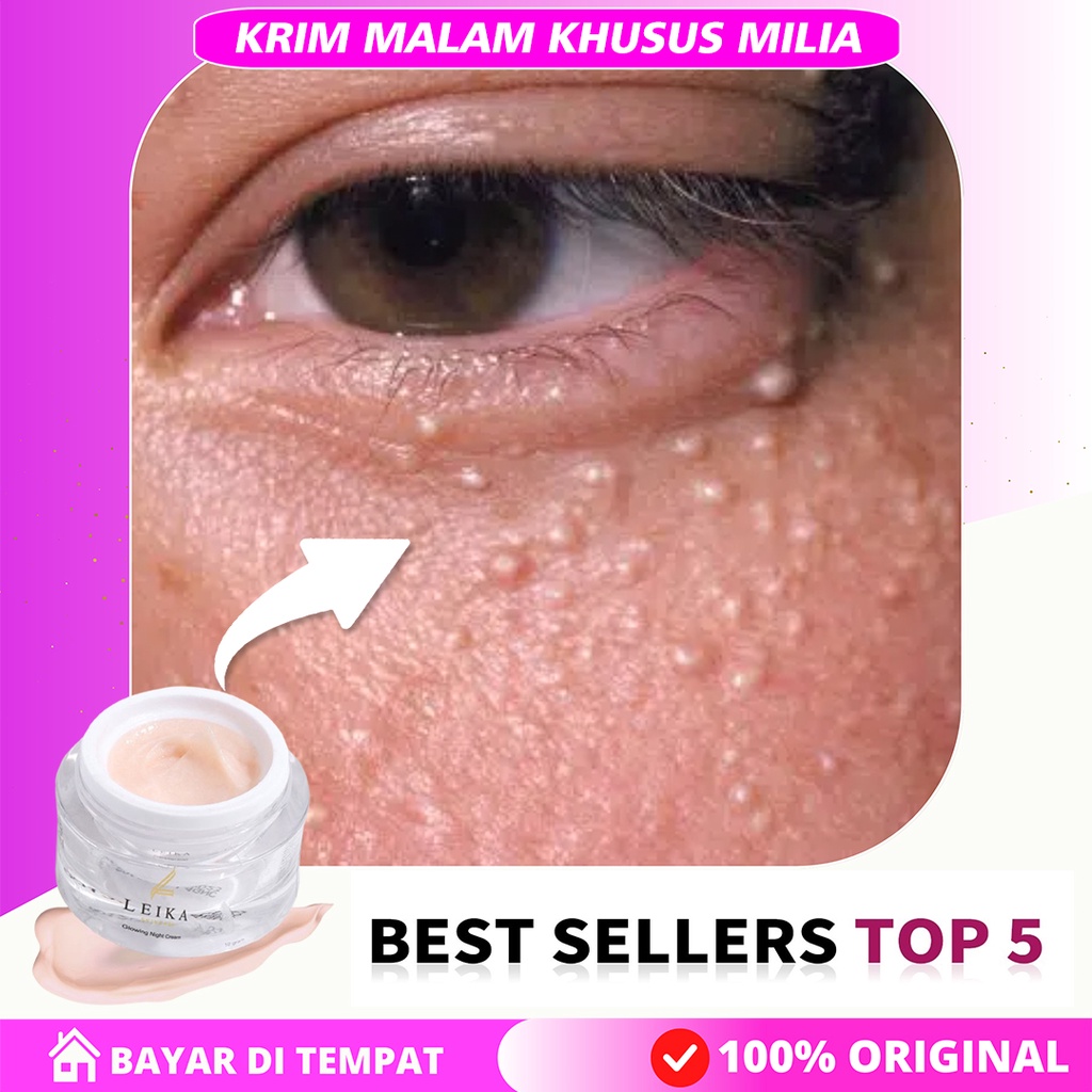 Jual ( TANPA MERKURI ) Bintik Putih di Ujung Mata, Di Atas / Bawah Mata ...