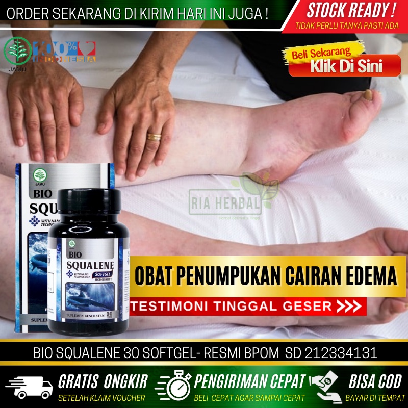 Jual Obat Edema Bengkak Di Tangan Dan Kaki, Penumpukan Cairan ...