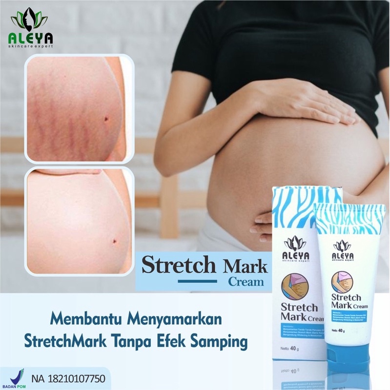Jual Stretch Mark Treatment Series (Stretch Mark Cream) Krim Anti ...