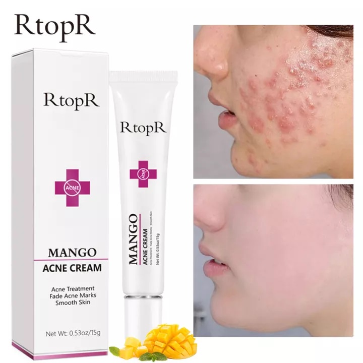 Jual RtopR MANGO Repair Acne Cream Cream Anti Acne Spots Acne Treatment ...