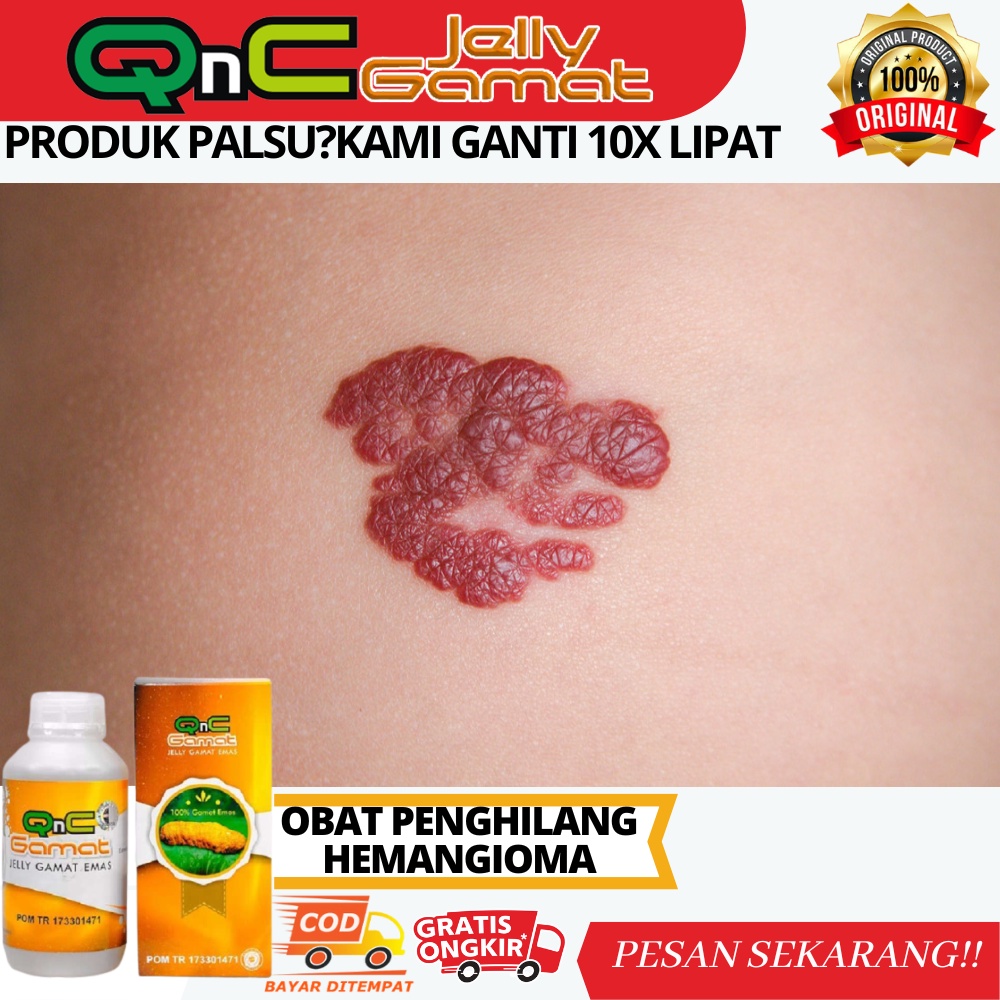 Jual Obat Penghilang Tanda Lahir / Hemangioma / Penghilang Tanda Lahir ...