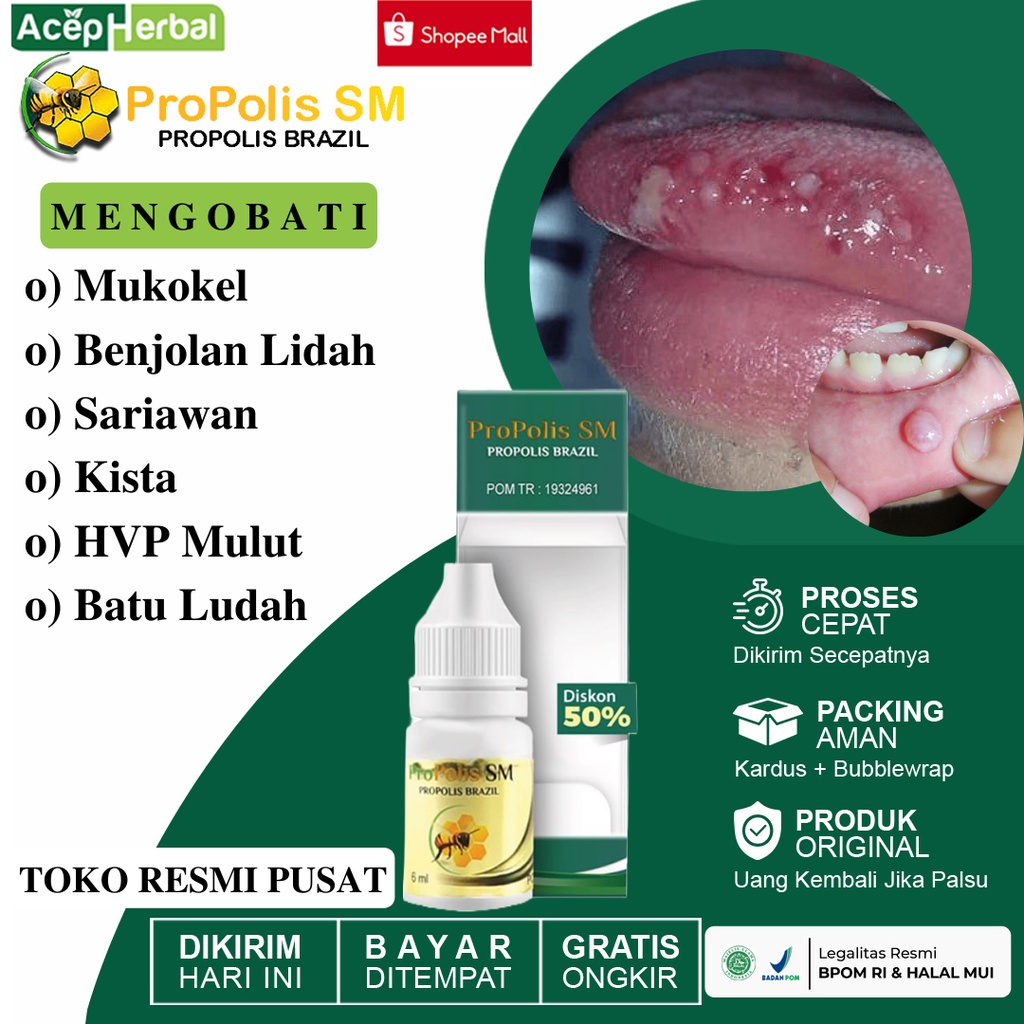 Jual Obat Mukokel Benjolan Lidah Sariawan Kista HPV Mulut Batu Ludah ...