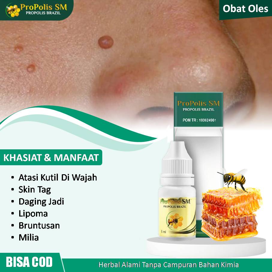 Jual Obat Tetes Kutil, Penghilang Kutil Di Wajah, Skin Tag, Bruntusan ...