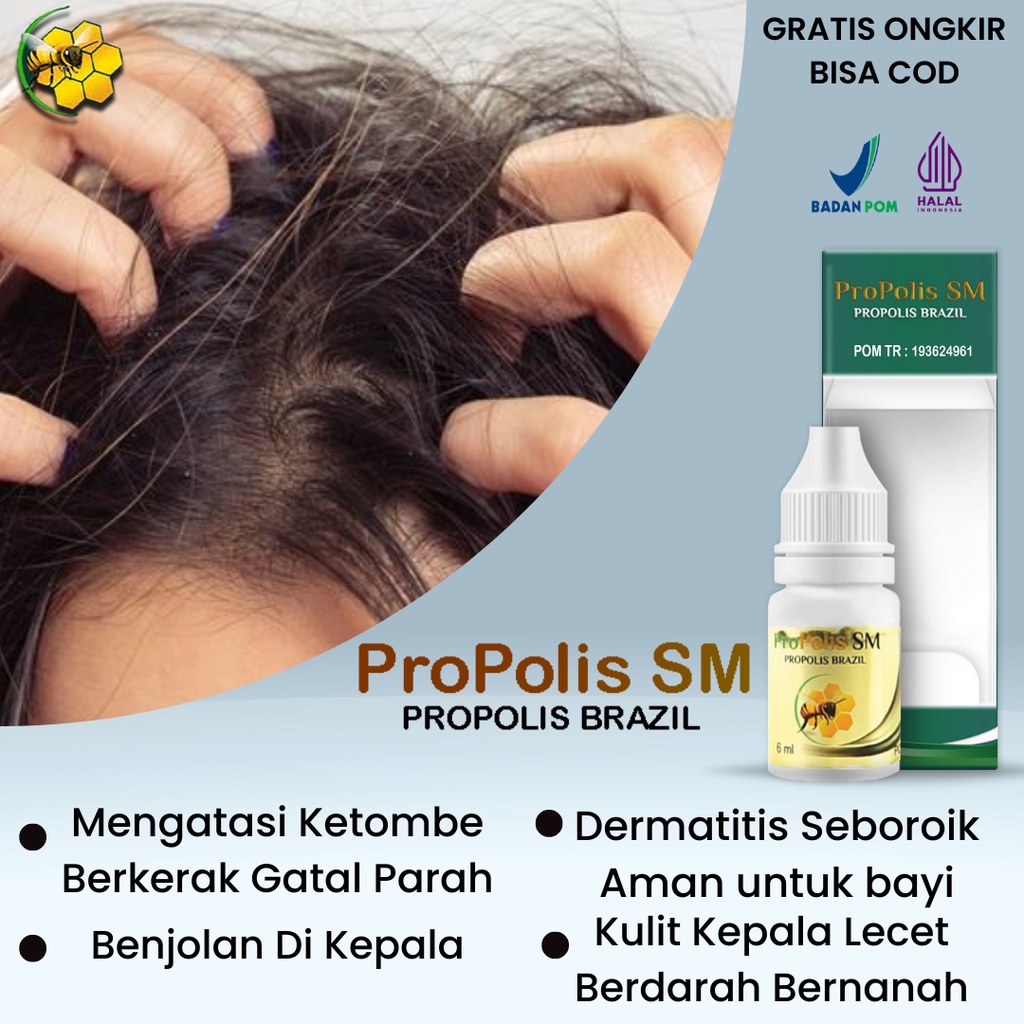 Jual Obat Tetes Psoriasis Kulit Kepala Borok Dermatitis Seboroik ...