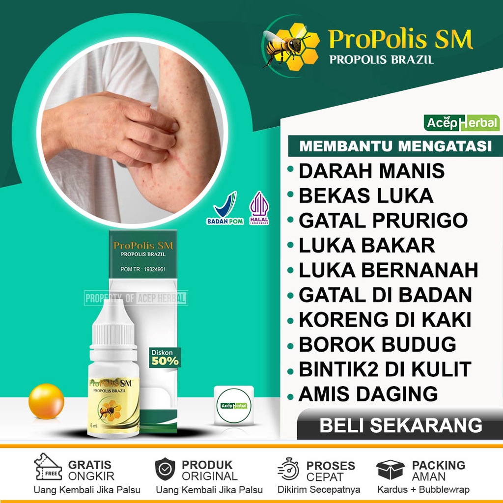 Jual Obat Darah Manis Dan Bekas Luka Gatal Prurigo di Tangan Kaki Badan ...