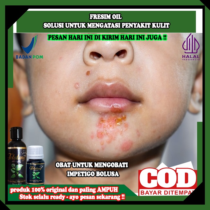 Jual Obat Impetigo Bolusa, Obat Oles Impetigo Bolusa, Obat Kulit ...
