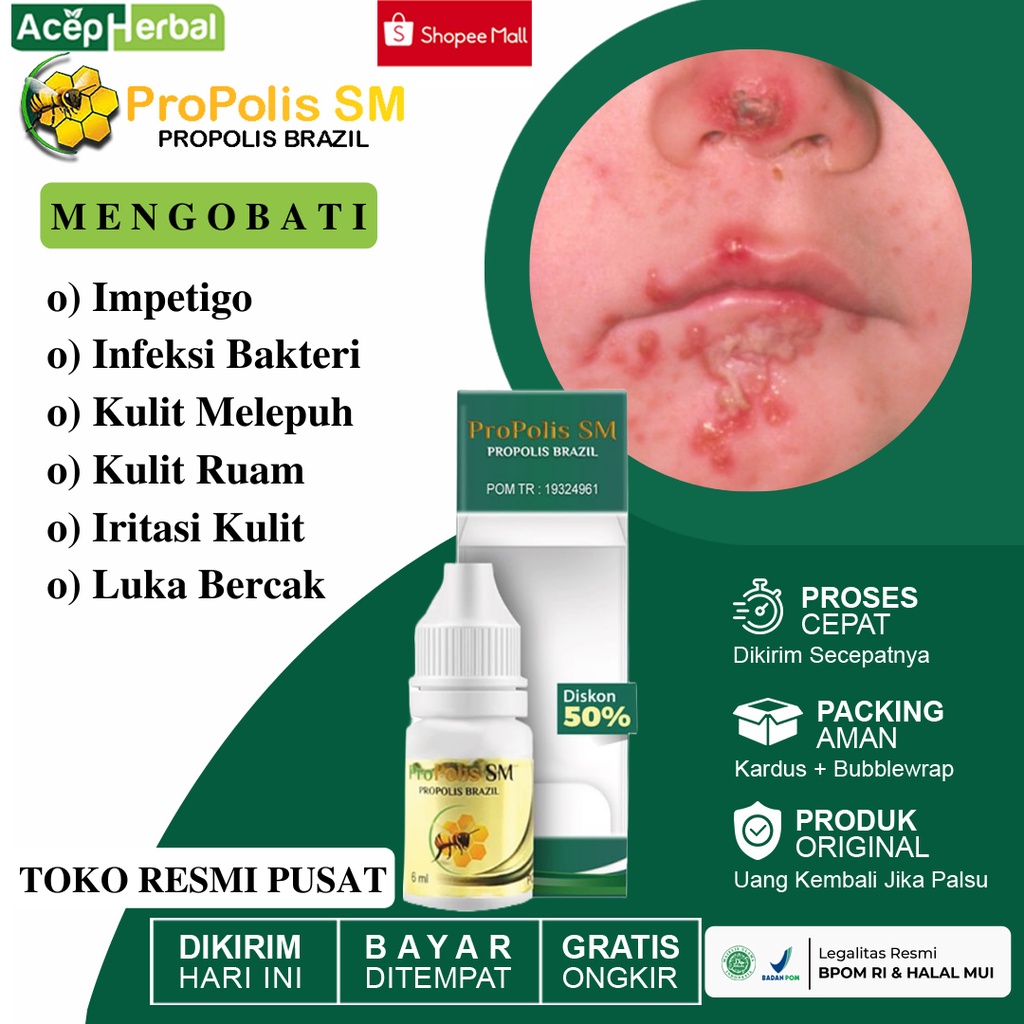 Jual Obat Impetigo Infeksi Bakteri Kulit Melepuh Kulit Ruam Iritasi ...